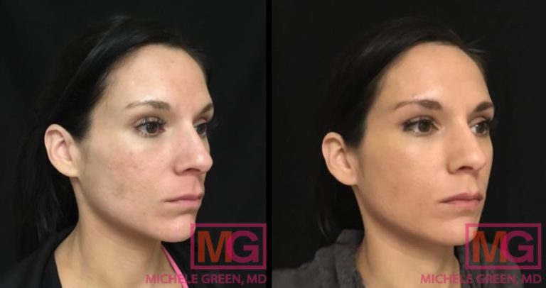 How to do Microneedling for Acne Scars - Dr. Michele Green M.D. NYC