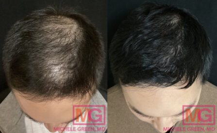 PRP Hair Loss, Hair Treatment & Restoration NYC - Procedures & Costs
