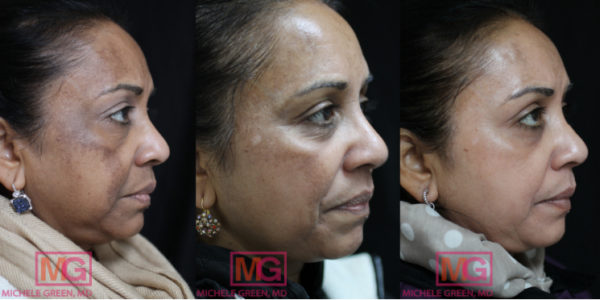 Tri-Luma Cream for Melasma - Dr. Michele Green M.D.