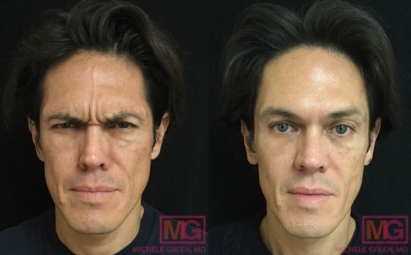 Botox vs Letybo - Dr. Michele Green M.D.