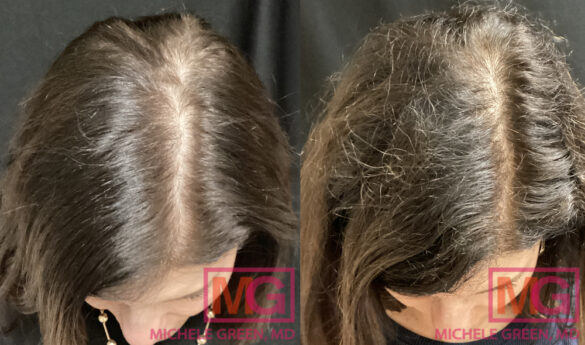 How Effective Is PRP For Hair Loss & Hair Growth? - Dr. Michele Green M ...