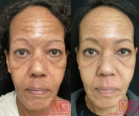 Post-Inflammatory Hyperpigmentation Treatment Options - Dr. Michele ...