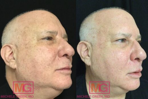 Seborrheic Keratoses Treatment, Causes & Dermatitis - Dr. Michele Green ...