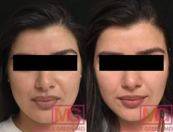 Botox TMJ (Temporomandibular Joint) & Jaw Area