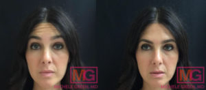 Botox vs Juvederm - Dr. Michele Green M.D.