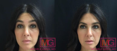 Botox Brow Lift, Forehead Lines, Hooded Eyes & Glabella