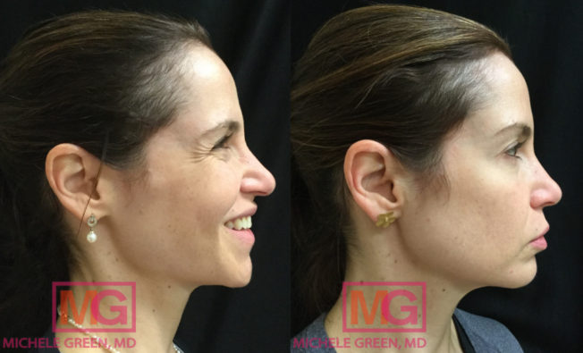 Non Surgical Eye Lift NYC, Lower Eyelid Lift - Dr, Mighele Green
