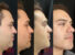 Kybella Swelling & Potential Side Effects, How To Lessen Swelling