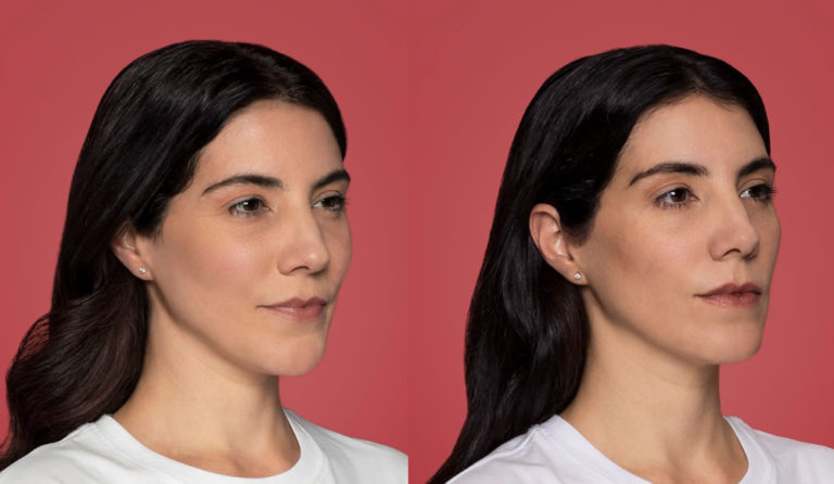 Restylane Contour for Cheek Augmentation - Dr. Michele Green M.D.