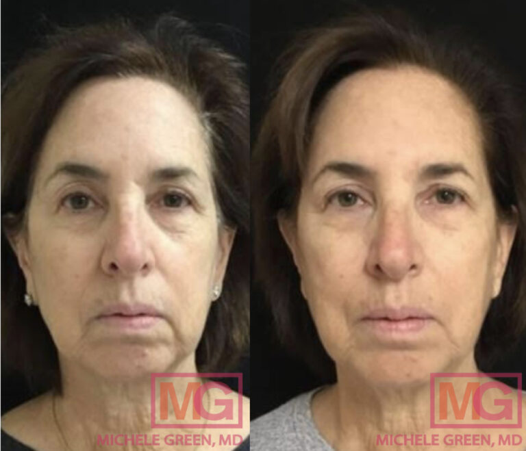 Photodynamic Therapy (PDT) & Blu-U Light for Actinic Keratoses NYC