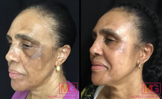 Tri-Luma Cream for Melasma - Dr. Michele Green M.D. NYC