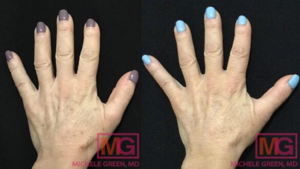 Sunspots Before & After Photos - Dr. Michele Green M.D. NYC
