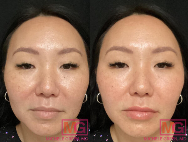 Lip Filler Migration, Preventing & Reducing Filler Migration - Dr ...