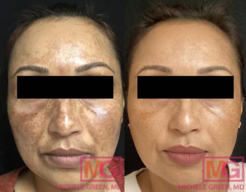 Melasma Treatment & Dermatology NYC