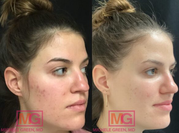 What is Comedonal Acne? - Dr. Michele Green M.D.