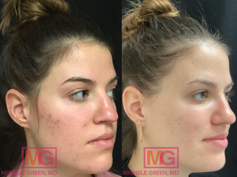 What is Comedonal Acne? - Dr. Michele Green M.D.