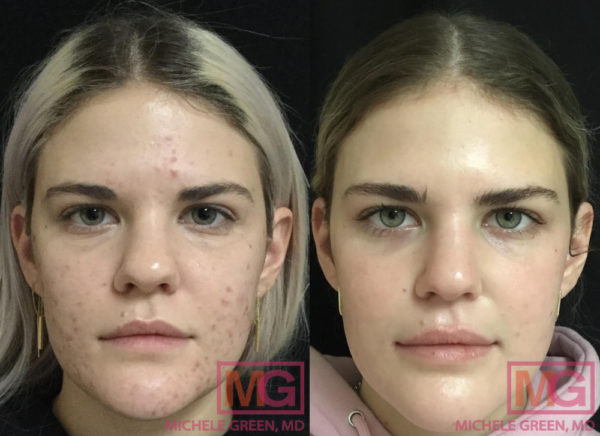 Subcision Acne Scars NYC, Acne or Chicken Pox Scars