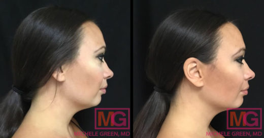 Kybella For Stomach Fat - Dr. Michele Green M.D. NYC