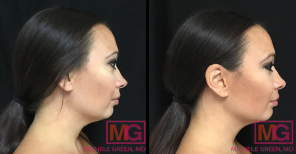 What Causes A Double Chin? - Dr. Michele Green M.D.