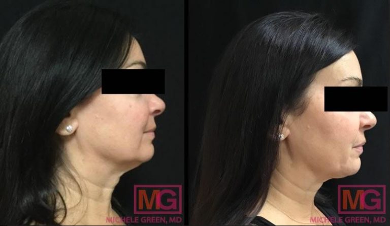 Kybella For Jowls & Cheek - Dr. Michele Green M.D.