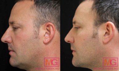 Kybella Before & After Photos - Dr. Michele Green M.D.