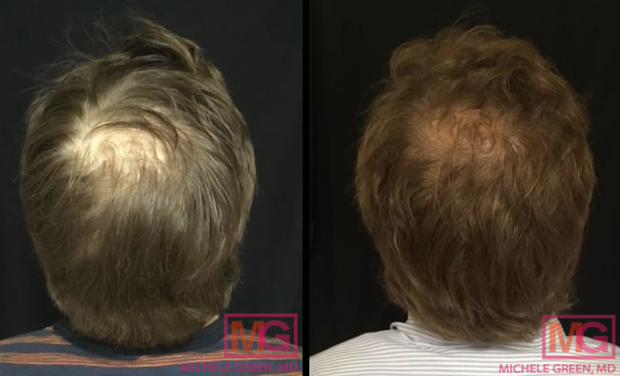 Alopecia, Alopecia Areata, Alopecia & Hair Loss Treatments