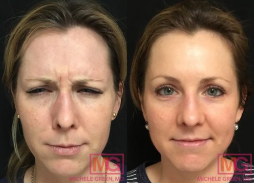 Botox Before & After Photos, Patient Photo, Pictures