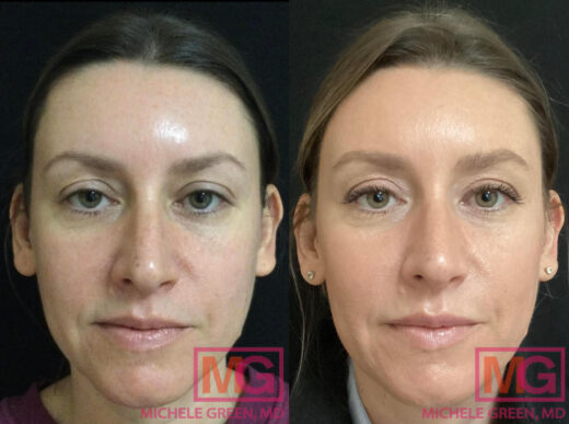 Lip Filler Migration, Preventing & Reducing Filler Migration - Dr ...