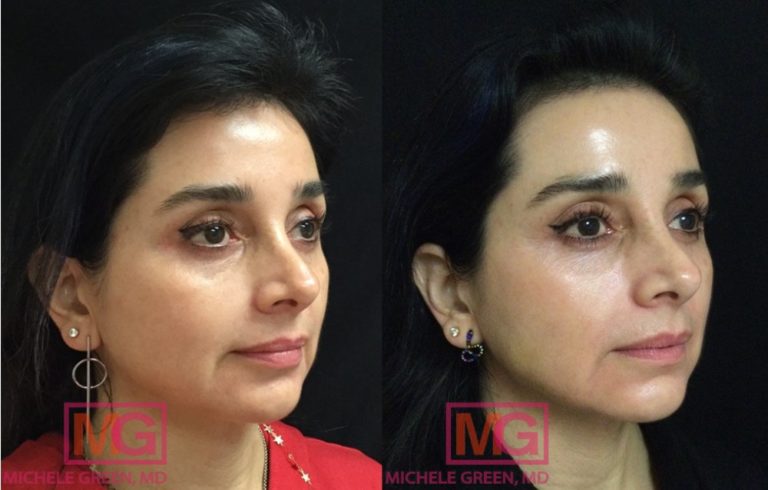 VBeam Before & After Photos - Dr. Michele Green M.D. NYC