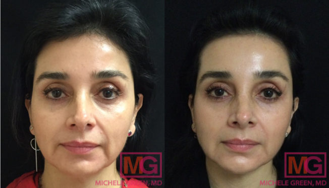 VBeam Laser NYC, V-Beam Laser Treatments - Dr. Michele Green M.D.