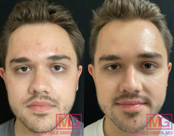 Microdosing Accutane - Dr. Michele Green M.D. NYC