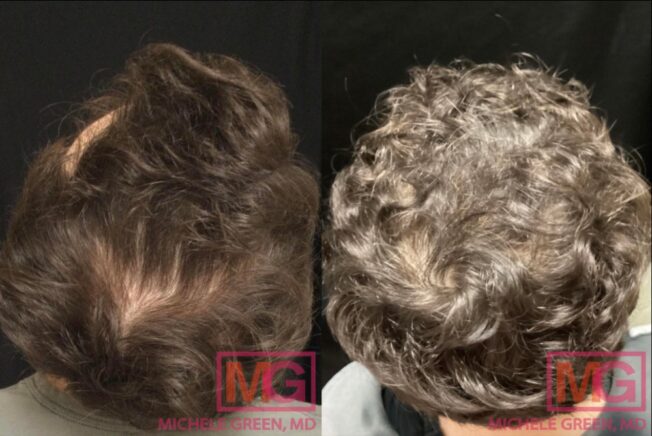 Does Low Testosterone Cause Hair Loss? - Dr. Michele Green M.D. NYC