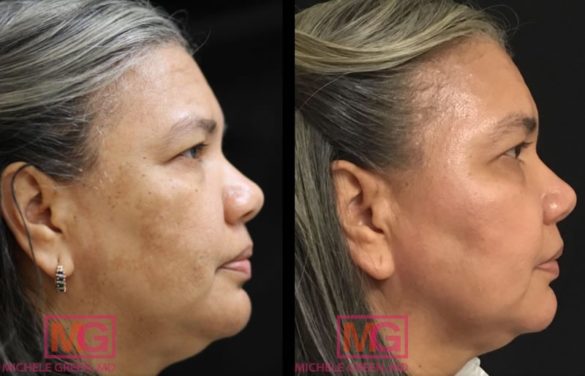 Tri-Luma Cream for Melasma - Dr. Michele Green M.D. NYC