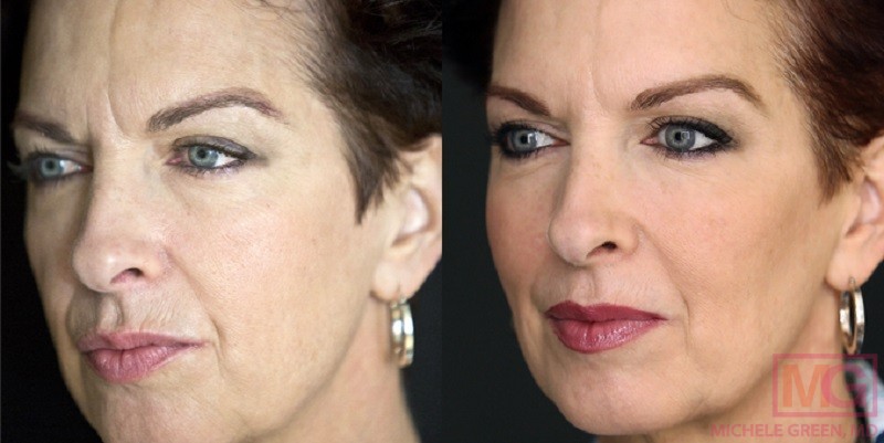 Botox Before & After Photos, Patient Photo, Pictures