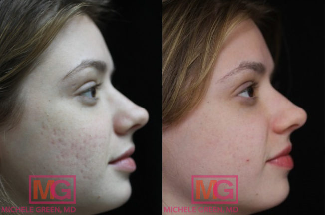 Chest Acne Treatment - Dr. Michele Green M.D.