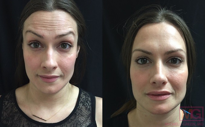 Before & After Photo Gallery - Michele Green M.D.