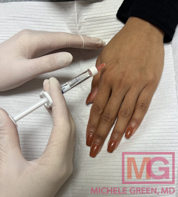 Hand Rejuvenation NYC, Laser Hand Rejuvenation Treatments