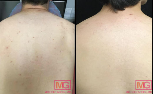 Back Acne, Causes & Treatment of Bacne - Dr. Michele Green M.D.