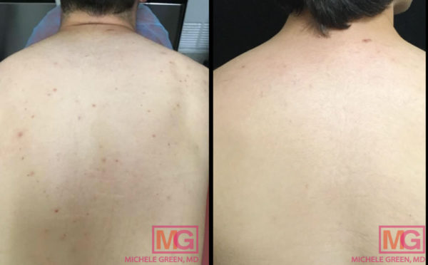 Back Acne, Causes & Treatment of Bacne - Dr. Michele Green M.D.