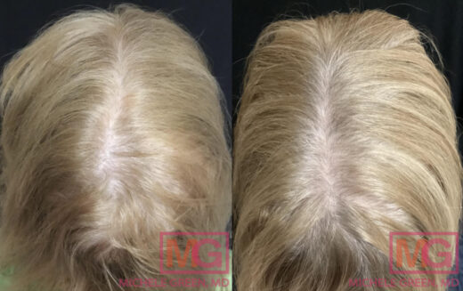 How Effective Is PRP For Hair Loss & Hair Growth? - Dr. Michele Green M ...
