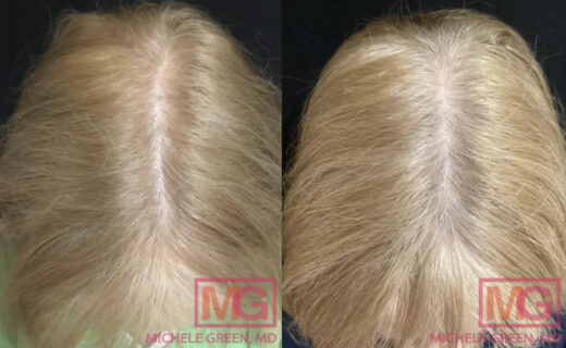 Non-Surgical Hair Loss Treatment - Dr. Michele Green M.D.