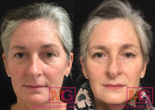 Botox vs Letybo - Dr. Michele Green M.D.