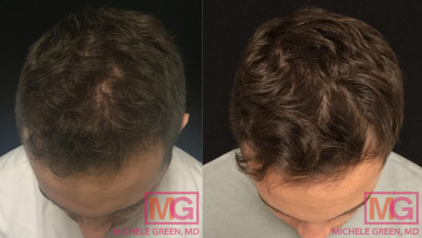 Oral Dutasteride for Hair Loss - Dr. Michele Green M.D.