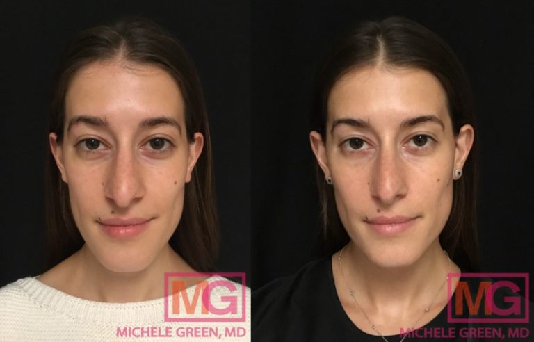 Restylane Before & After Photos, Lyft, Under Eyes & Cheeks