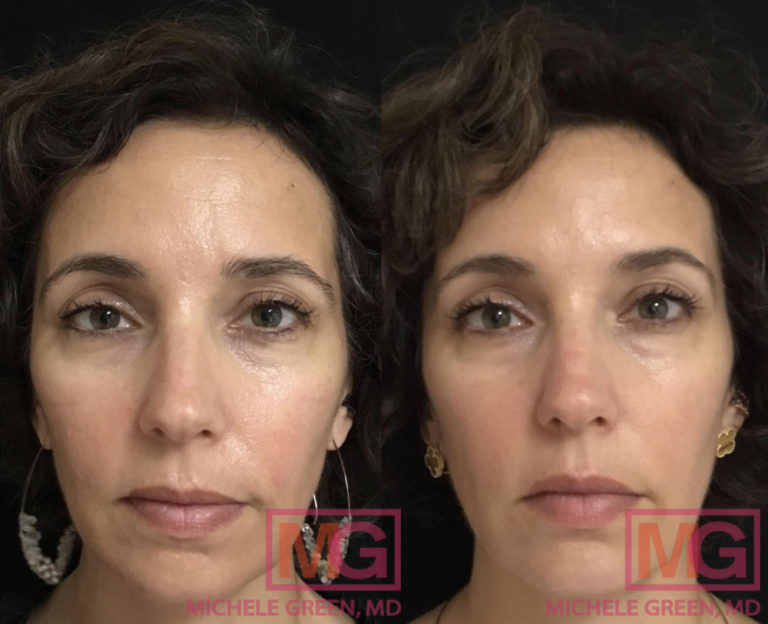Botox in a Bottle: What is Behind This Current Trend? - Dr. Michele ...