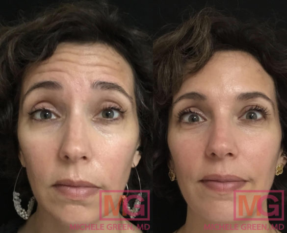 Botox for Forehead Wrinkles & 11 Lines - Dr. Michele Green M.D.