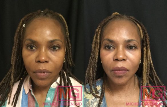 The Best Creams for Melasma - Dr. Michele Green M.D.