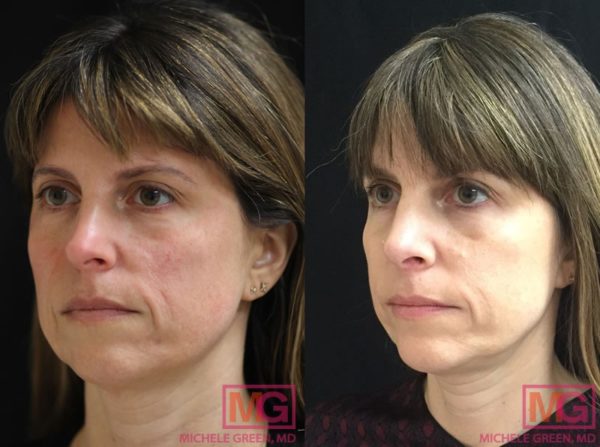 How to Get Rid of Jowls, Treatments for Sagging Jowls - Dr. Michele ...
