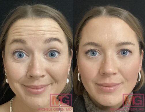 Baby Botox & Natural Looking Results from Botox in NYC