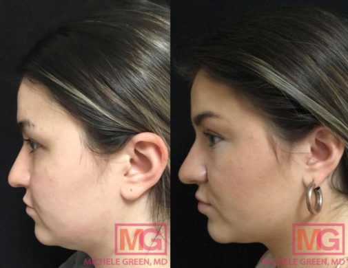 Kybella Neck Lift, Kybella for Neck Fat - Dr. Michele Green M.D.